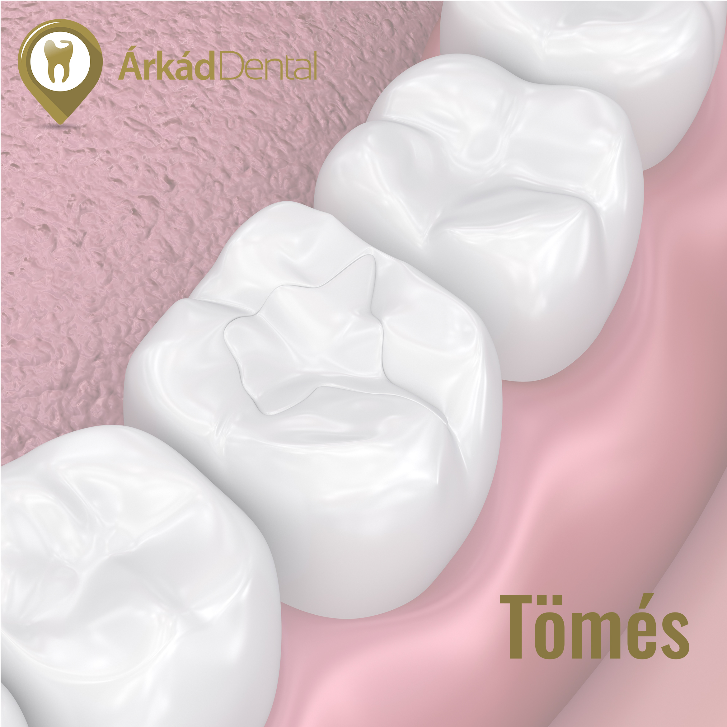 Konzerváló fogászati kezelések | Árkád Dental Fogászat Budapest